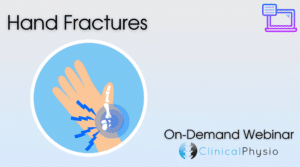 Hand Fractures | Clinical Physio